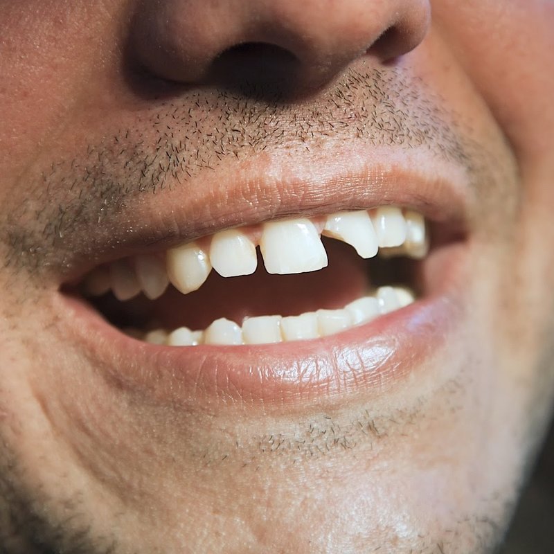 Rak v ustni votlini - Clarus dentalni center